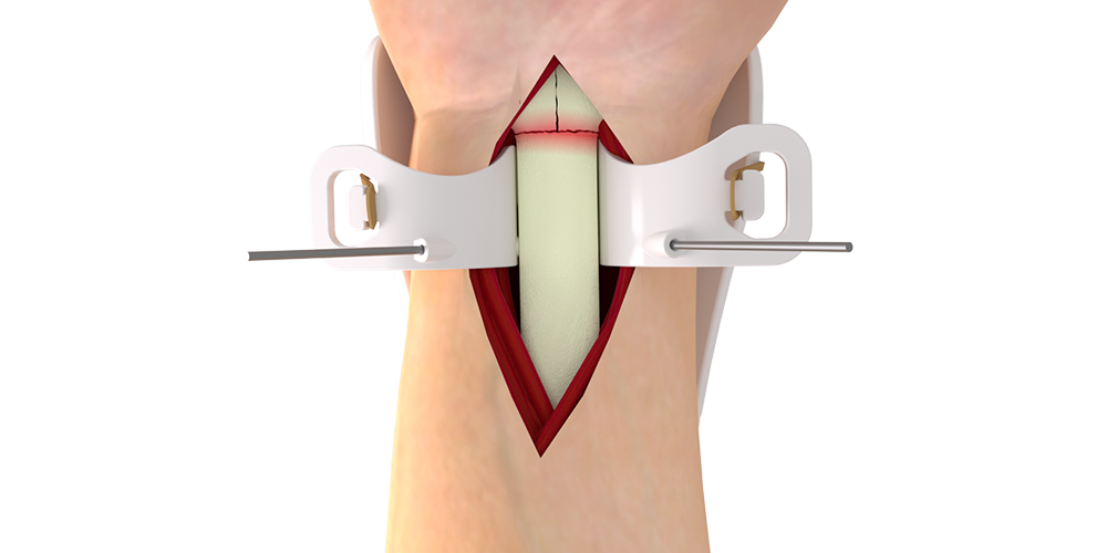 Technology - RetractOrtho